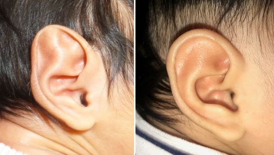 Dr. Shareef Jandali: Infant Ear Molding - Stamford Moms